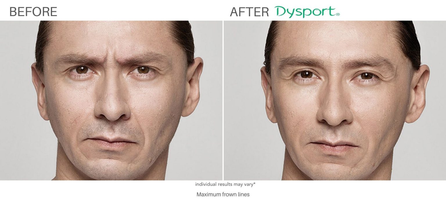 Botox & Dysport | FDA Cleared, Safe & Effective for Fine Lines & Wrinkles